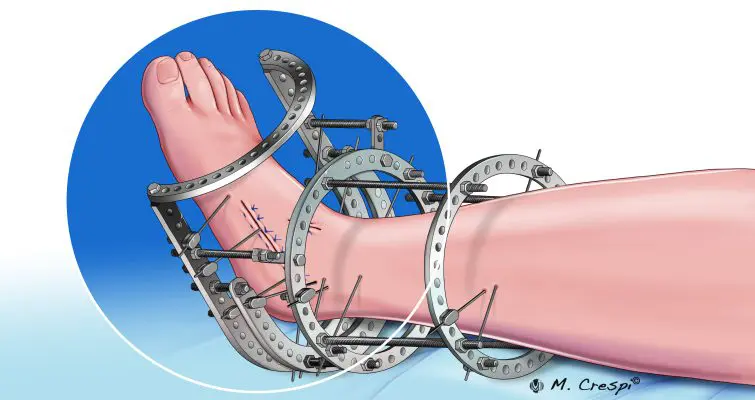 Charcot Foot Natural Treatment Types Of Methods And Benefits
