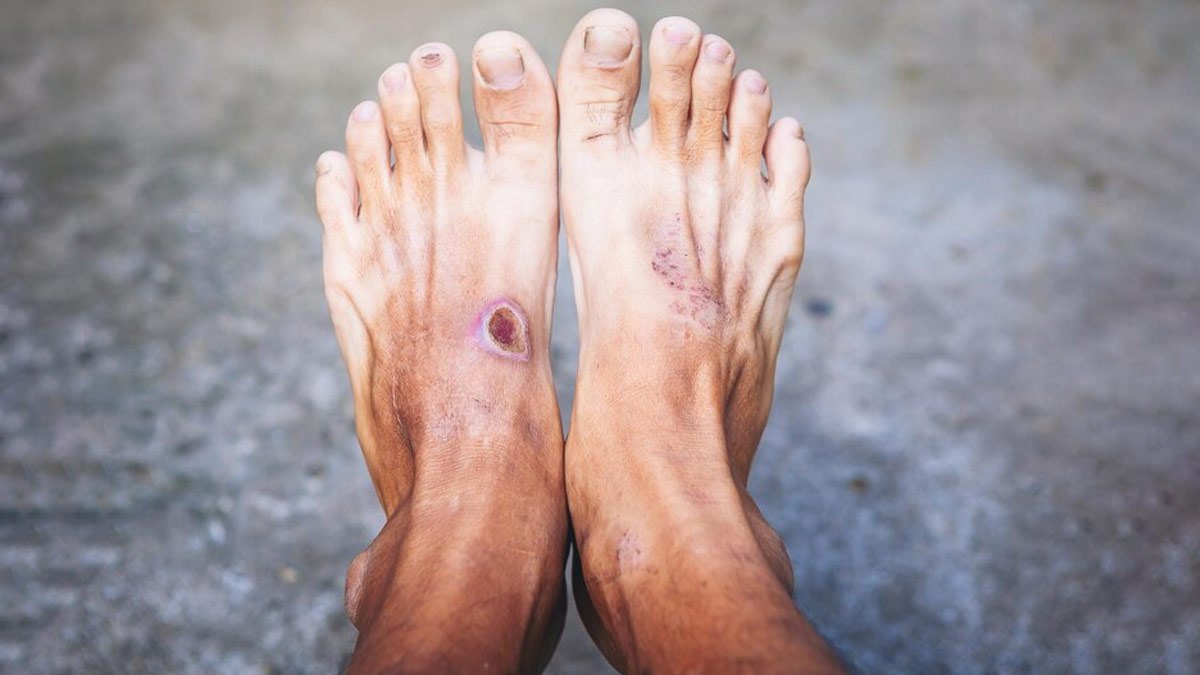 Diabetic Wound Treatment: Best Approaches & Time To Heal